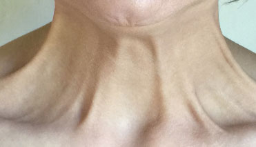 Jowls, Jawline And Neck - DrAtulKathed